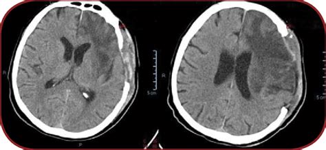 Cerebral Ct Scan Performed At 10 Days After Decompressive Craniectomy
