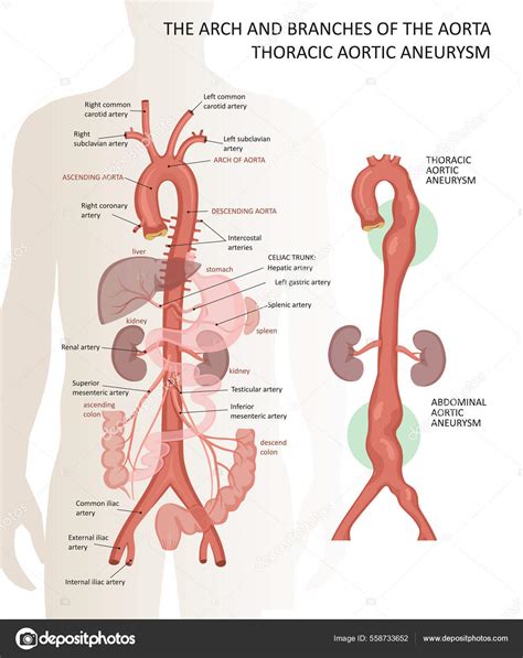 The Arch And Branches Of The Aorta Thoracic Aortic Aneurysm Vector De Stock Por ©nnfotograf