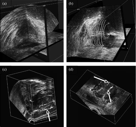 Three Dimensional Prostate Images Obtained With A Trus Ultrasound Download Scientific Diagram
