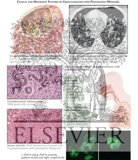 Watermarked Preview Of Labeled Image Vasculitis Clinical And Histologic Features Of
