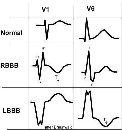 Left Bundle Branch Block Lbbb Ecg Criteria Causes Management Artofit