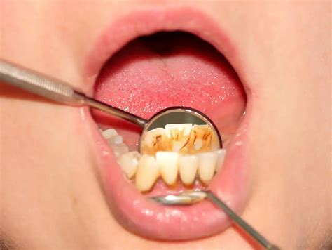 Plaque Vs Calculus What Is The Difference Your Dentist Hawthorn