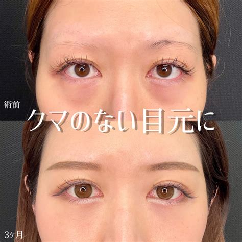 目の下の脱脂と裏ハムラ法の違いや手術をして10年後を医師が解説｜美容整形は東京シンデレラ美容外科 新宿池袋大宮