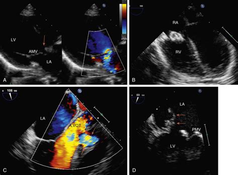 Infective Endocarditis Thoracic Key