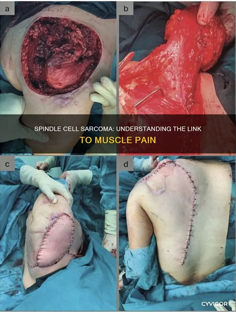 Spindle Cell Sarcoma Understanding The Link To Muscle Pain Cyvigor