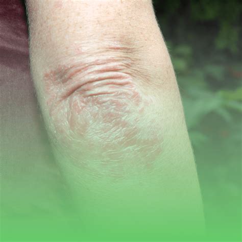 Psoriatic Arthritis Understanding The Connection Psodex
