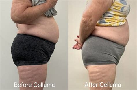 Led Red Light Therapy Before And After Results Celluma