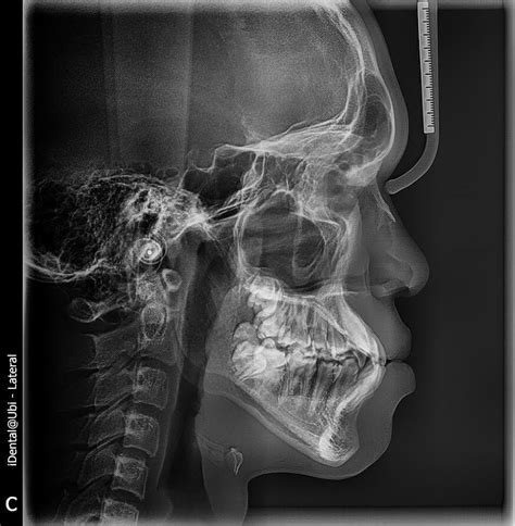 What Should I Do With My Underbite Rorthotropics