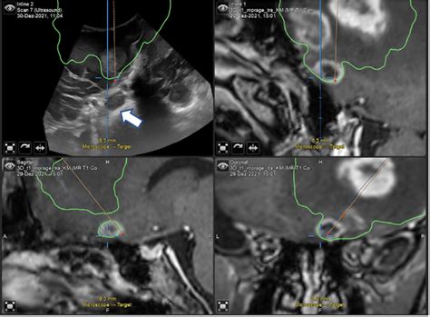 Live Ius Guided Resection At 50 Of Tumor Removal Showing The Download Scientific Diagram