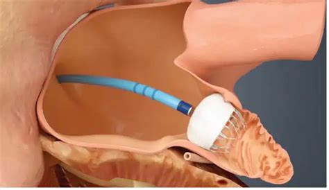 What Is Left Atrial Appendage Occlusion For Atrial Fibrillation Af Asian Heart And Vascular