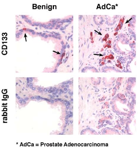Cd133 Expression In Benign And Malignant Prostate Cd133 Immunostaining