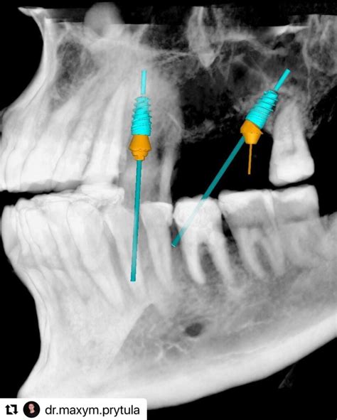 Guided Surgery As An Alternative To Subantral Augmentation Surgical