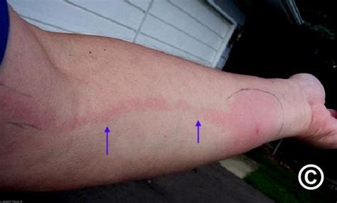 Erysipelas Vs Cellulitis