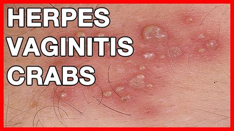 How Do Crabs Look Like The Std At Sarah Scoggins Blog