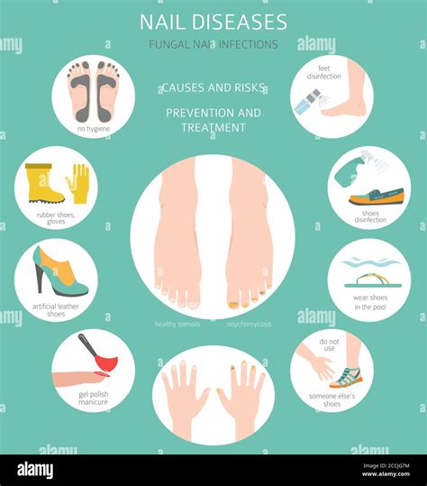 Nail Diseases Onychomycosis Nail Fungal Infection Causes Treatment