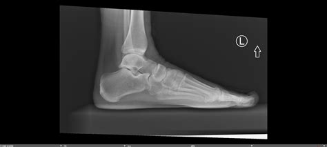 Avascular Necrosis Avn Of Sesamoid — Chicago Foot And Ankle Orthopaedic Surgeons