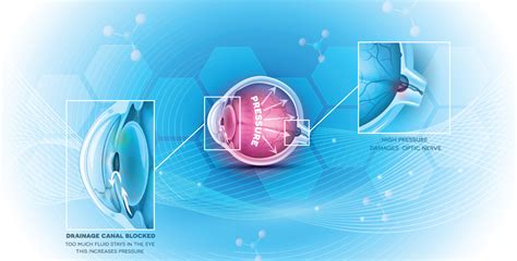 Glaucoma Warning Signs And Early Symptoms Vision Clinic