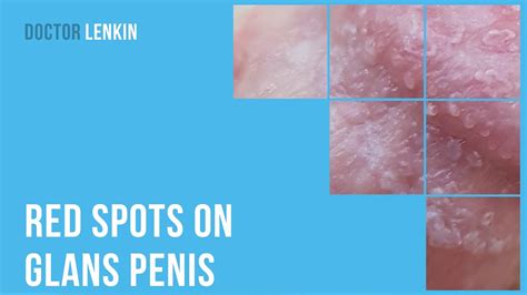 Red Spots On Penis 10 Causes Penis Sores 12 Causes And Treatments Pehfp