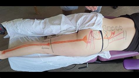 Sciatica Anatomy Oakville Chiropractor Youtube