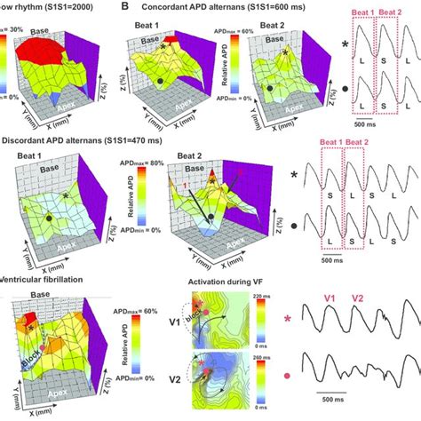 Transition From Spatially Concordant To Discordant Alternans During A
