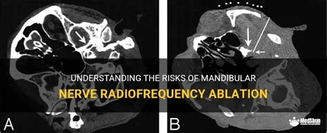 Understanding The Risks Of Mandibular Nerve Radiofrequency Ablation