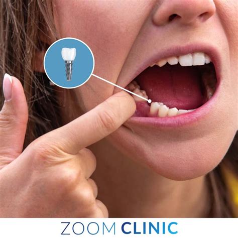 Dental Implants For Multiple Missing Teeth Solutions And Strategies