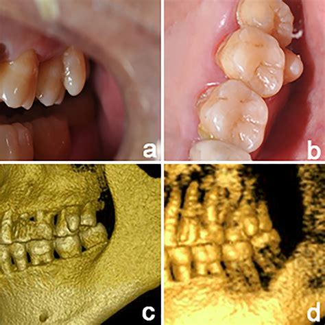 What Is That A Tooth With A Supernumerary Cusp Atlas Of Science