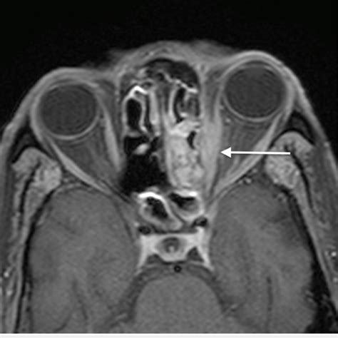 Preseptal Cellulitis With Abscess Axial Post Gadolinium T1wi Shows Download Scientific Diagram
