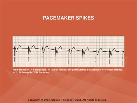 Cardiac Dysrhythmias Ppt Download