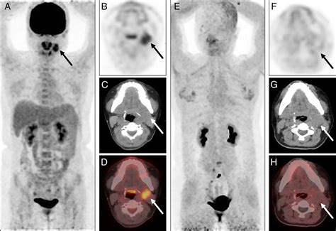 18f Fdg Petct Versus 68ga Fapi Petct In A Case Of Isolated