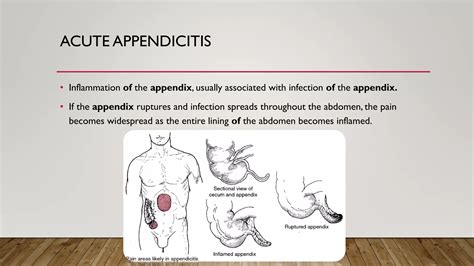 Acute Appendicitis Pdf
