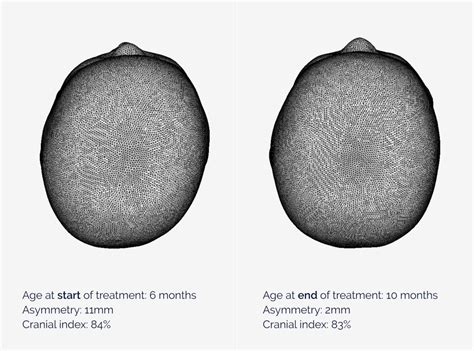 Kingston Patient Freddies Plagiocephaly Improves In Just Four Months