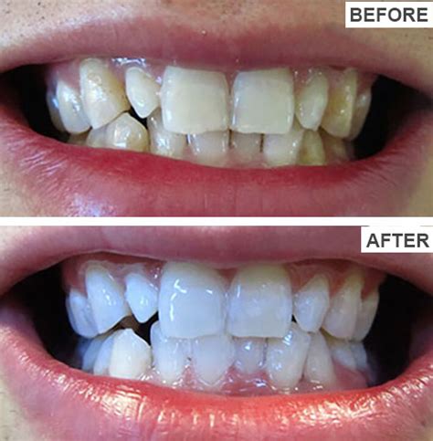 Deep Cleaning Teeth Cleaning Before And After At Christopher Ardoin Blog