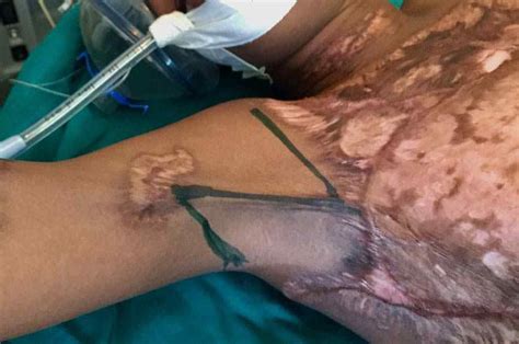 Different Types Of Contractures Basics Of Burn Care