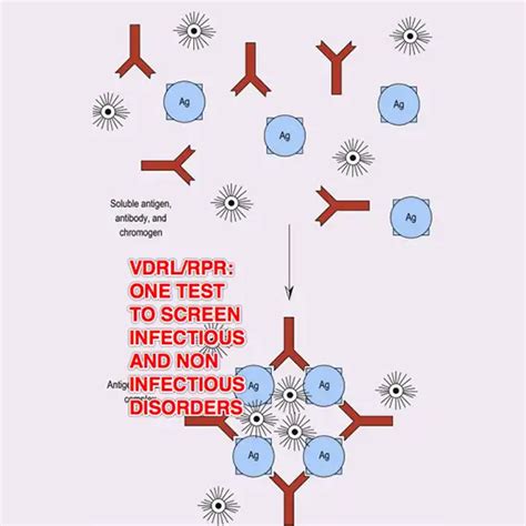 Vdrl Rpr Serum Test Price In Delhi Cost Near Me India Ganesh Diagnostic