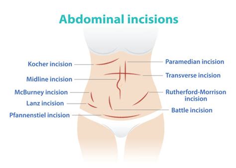 Open Appendectomy Incision