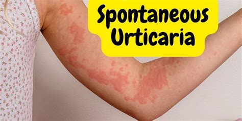 Chronic Spontaneous Urticaria Diagnosis And Management Private Allergy Testing In