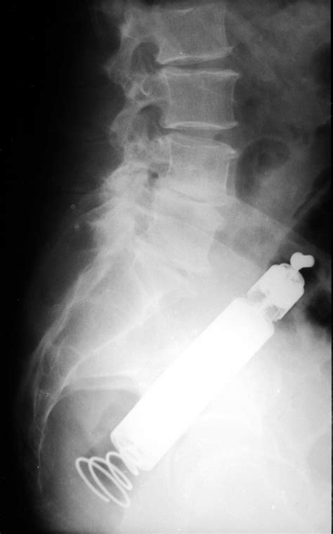 Foreign Bodies Insertions
