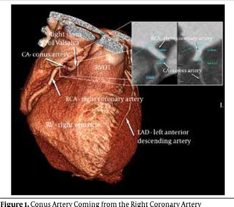 Figure 1 From Conus Artery In Coronary Ct Angiography Semantic Scholar