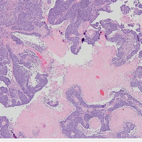 Low Power View Of The Tumor Showing Papillary And Solid Architectural Download Scientific