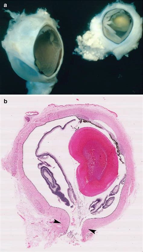 Glaucoma Vs Leucoma Causas Tratamiento Y Diagnóstico