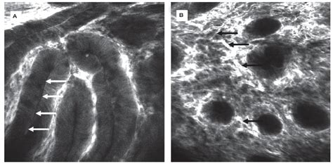 Confocal Laser Endomicroscopy Current Indications And Future