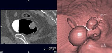 Multidetector Computed Tomography Virtual Cystoscopy An Effective Diagnostic Tool In Patients