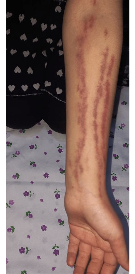 Linear Drug Eruption Or Lymphangitis Rdermatologyquestions