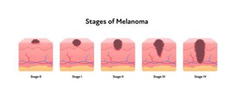 How Fast Does Squamous Cell Skin Cancer Spread