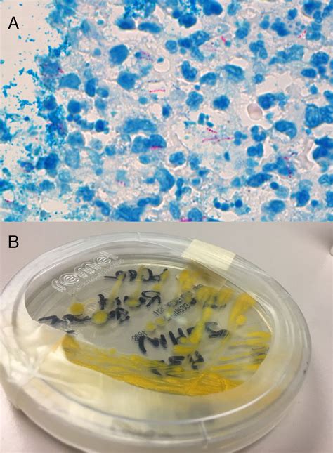 A Case Of Severe Cutaneous Mycobacterium Marinum Infection In A Patient