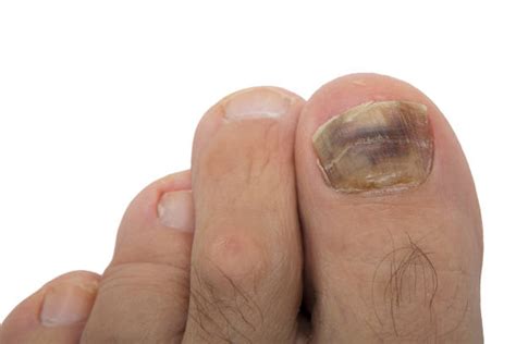 Toenail Fungus Or Melanoma