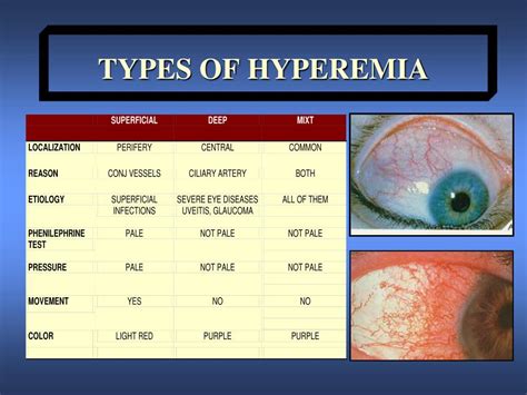 Ppt Red Eye Powerpoint Presentation Free Download Id5628078