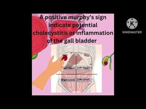 Understanding Murphys Sign A Quick Guide Cholecystitis