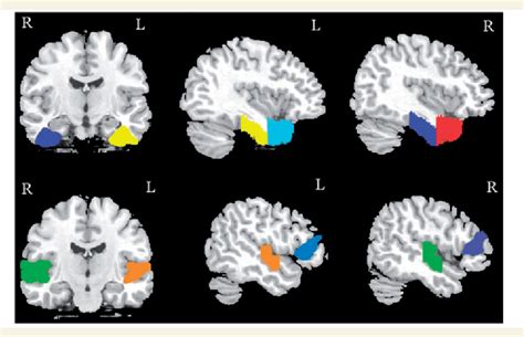 Figure 1 From What The Left And Right Anterior Fusiform Gyri Tell Us About Semantic Memory